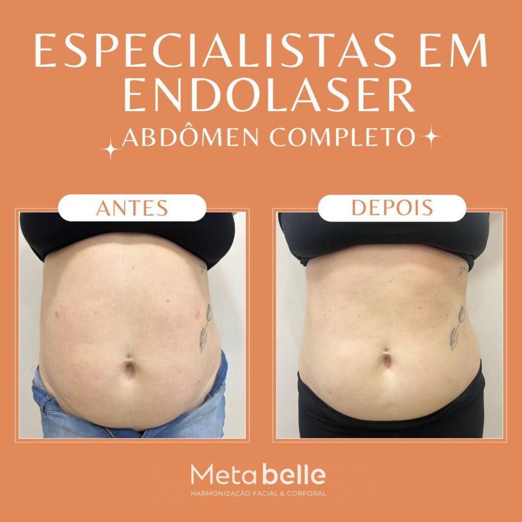 Endolaser2 – Metabelle